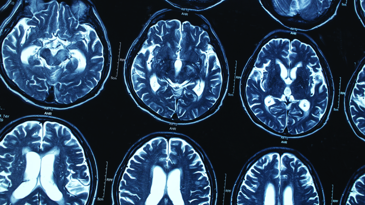 Measuring multiple sclerosis (MS) - a glossary