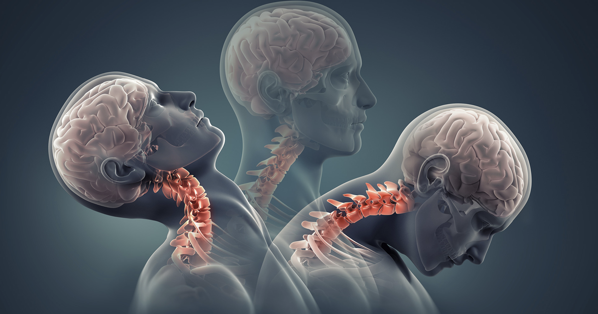 Ik heb een whiplash. Oorzaak en behandeling