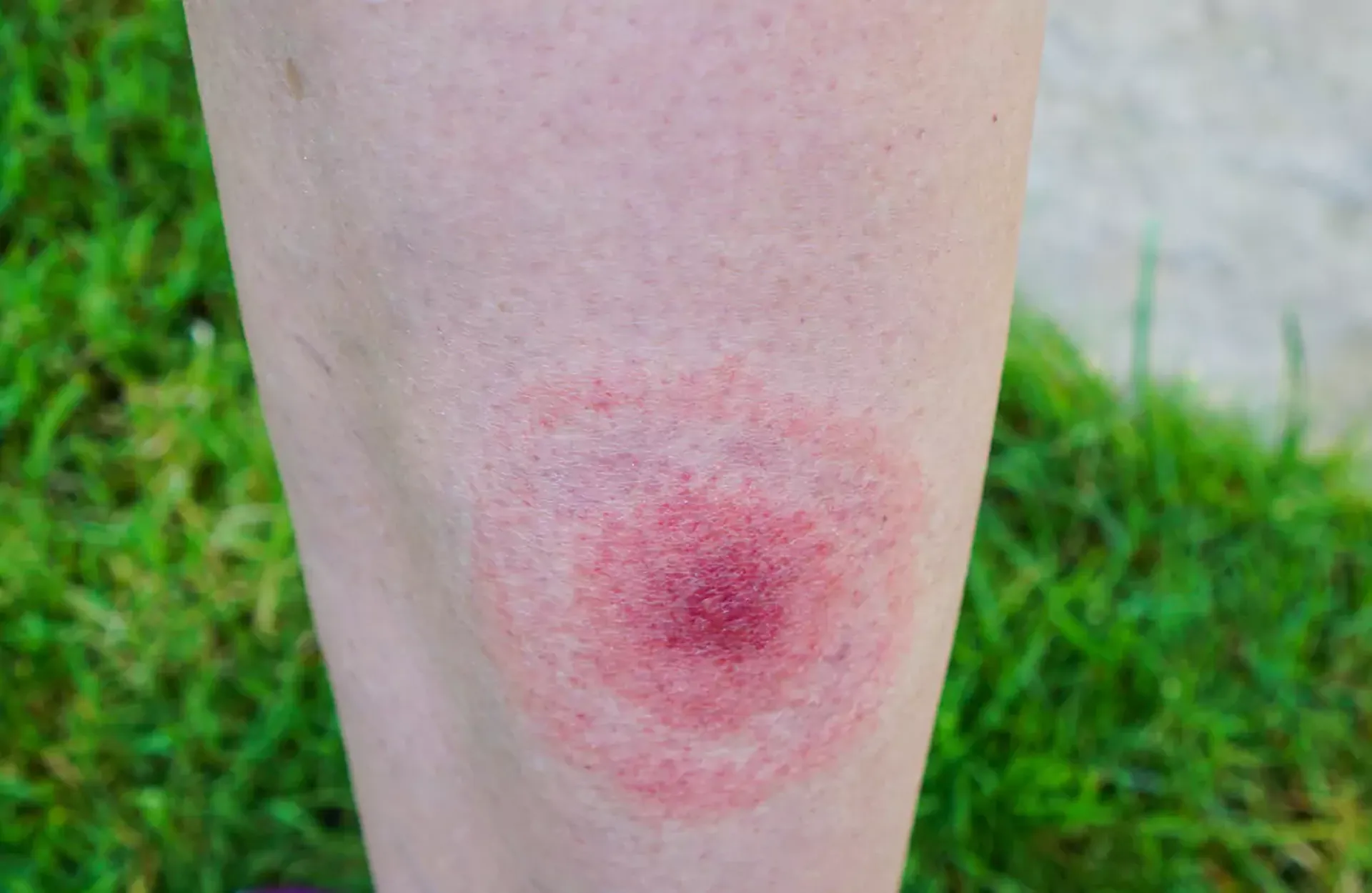 Borrelia – orsak, symtom och behandling - Doktor.se