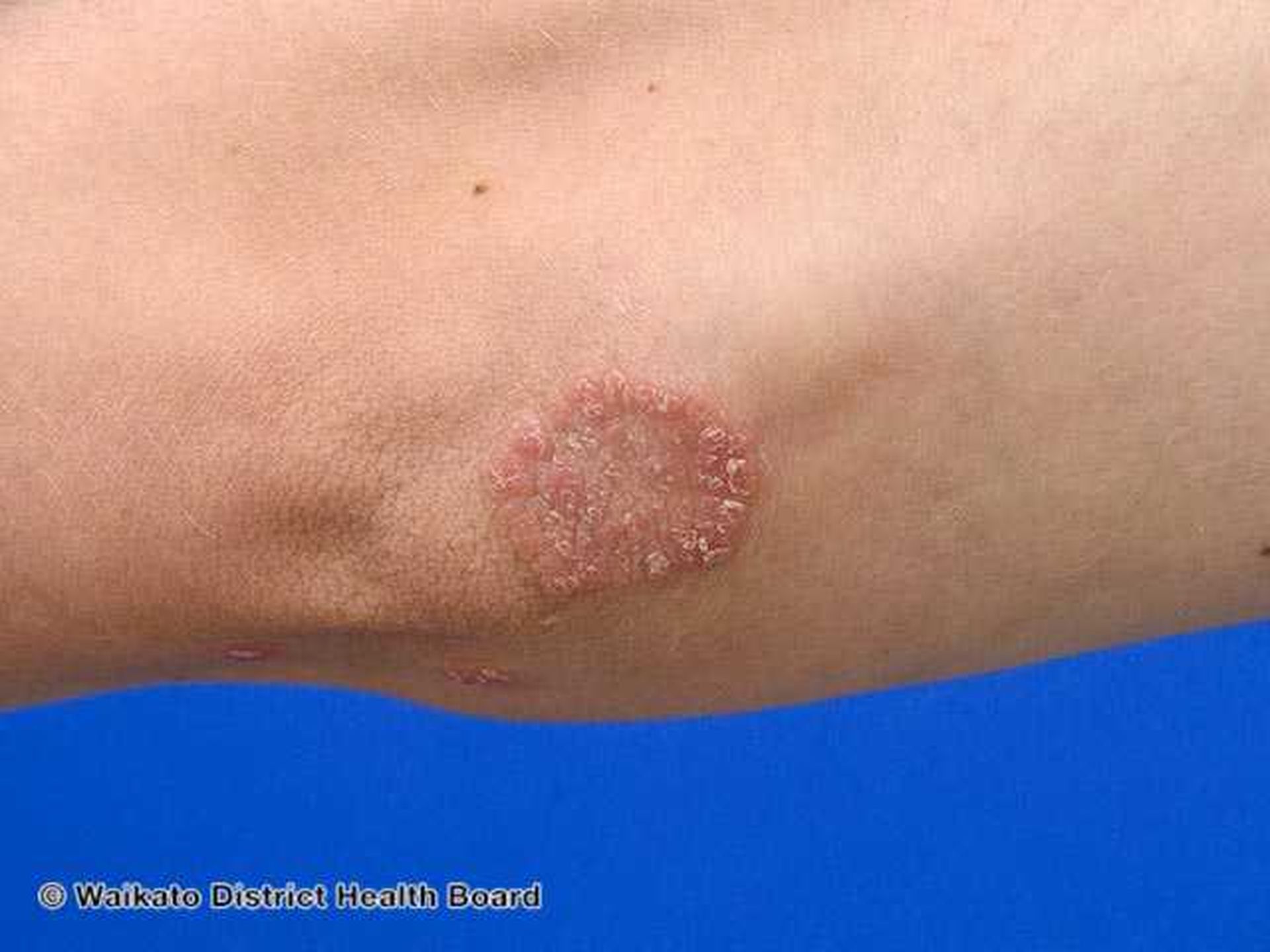 Psoriasis – orsak, symtom och behandling - Doktor.se