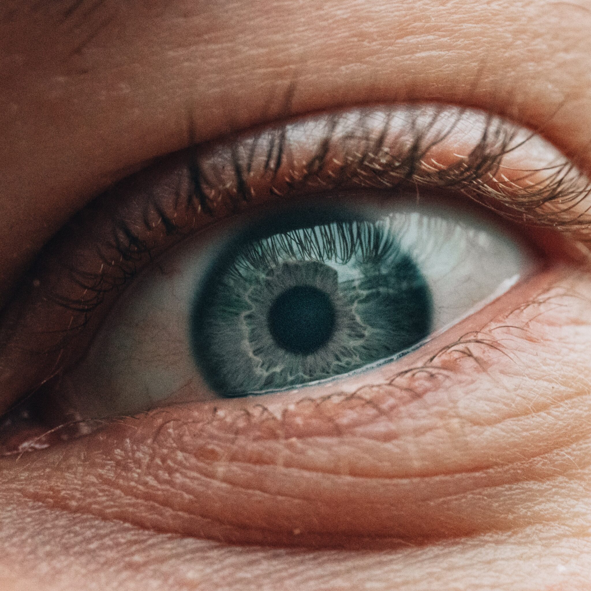 Correzione del solco lacrimale con il Filler | Dr. Zaccheddu