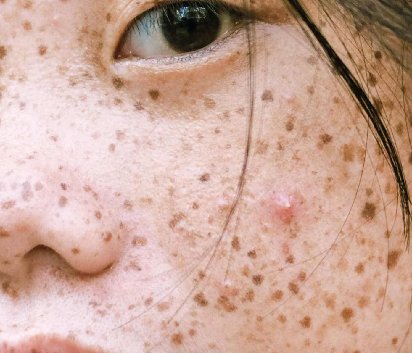 Welche Pickel-Arten gibt es und welche habe ich?