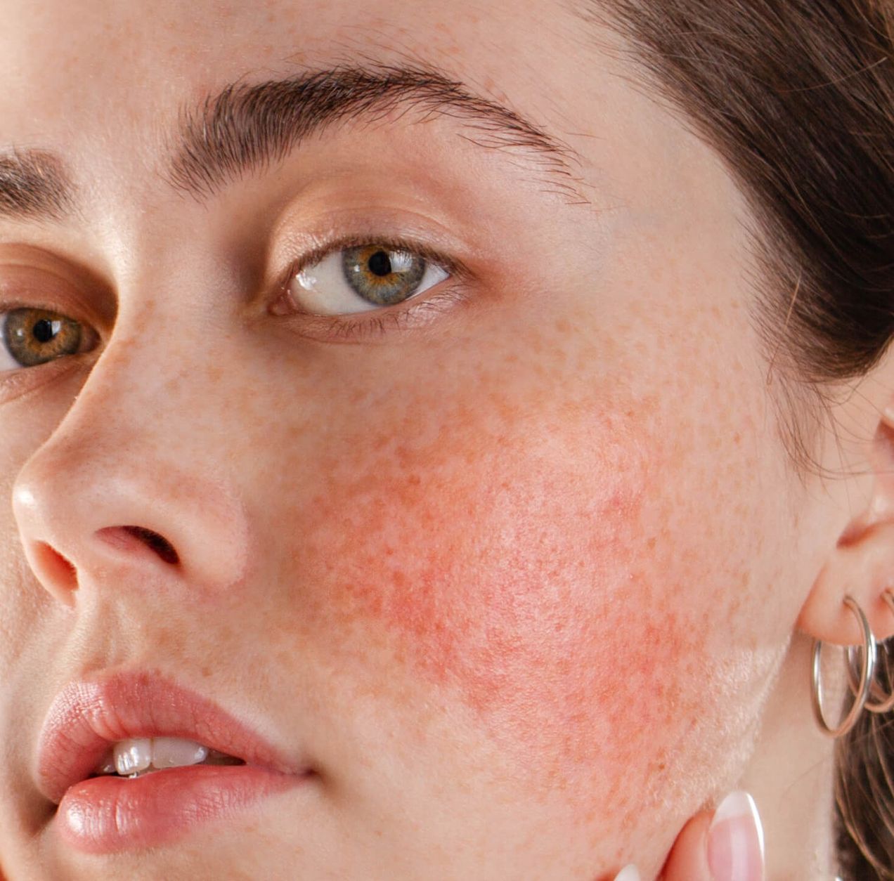 Individuelle Rosacea-Routine für Deine Bedürfnisse