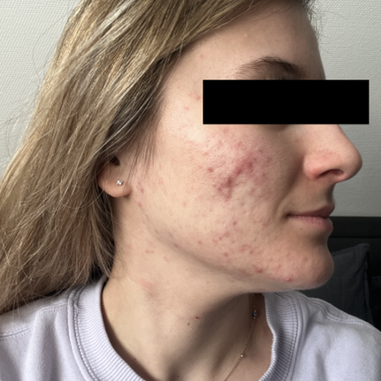 Pickel auf den Wangen – So wirst Du sie effektiv los!