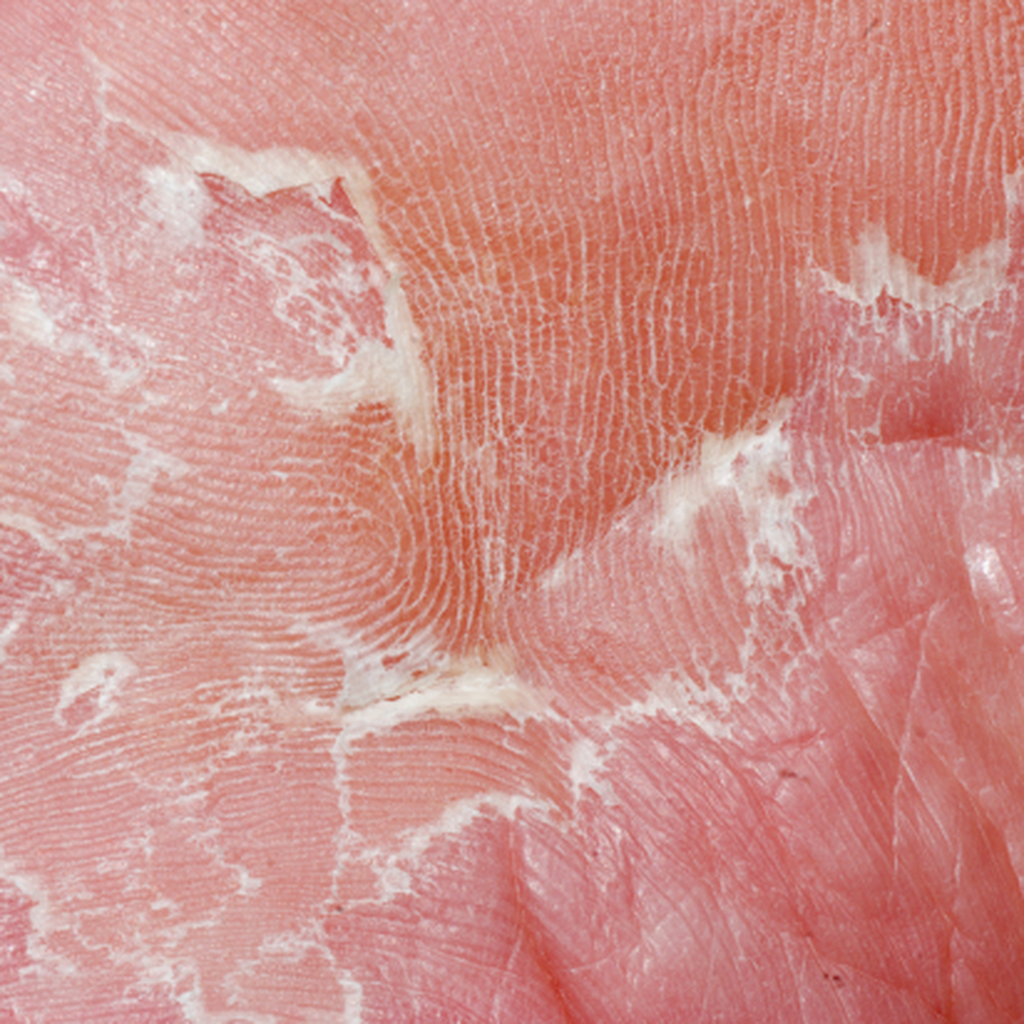 Hyperkeratose an Hand & Fuß – Diagnose & Behandlung