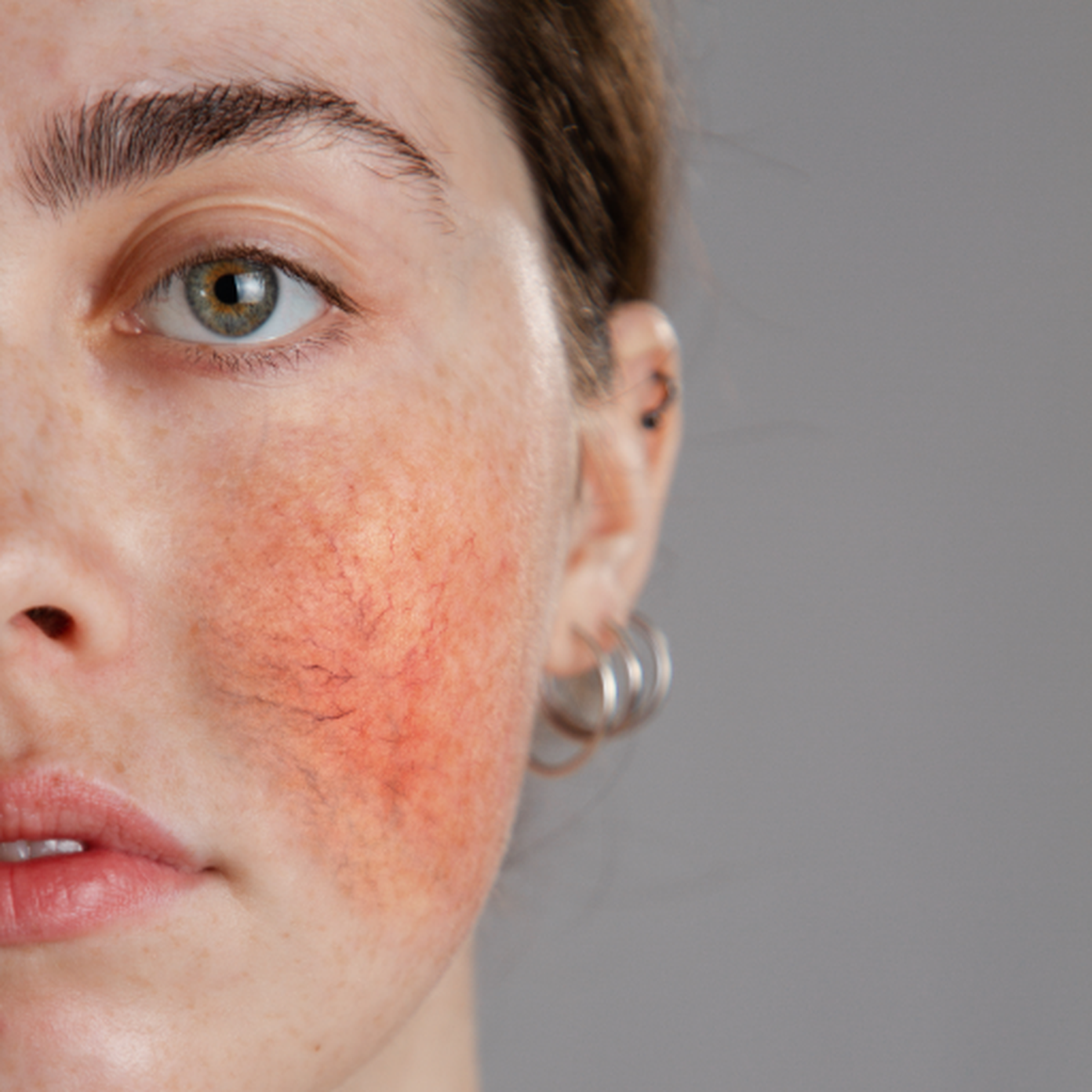 Rosacea – erfahre mehr über die drei Krankheitsstadien