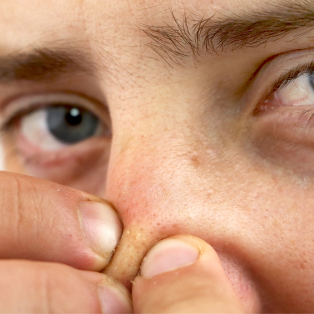 Mitesser entfernen – So wirst Du sie endlich los!