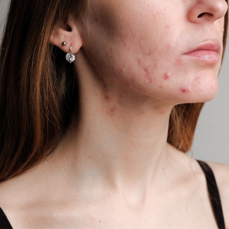 Was ist Akne? Ursachen & Behandlung | FORMEL Skin