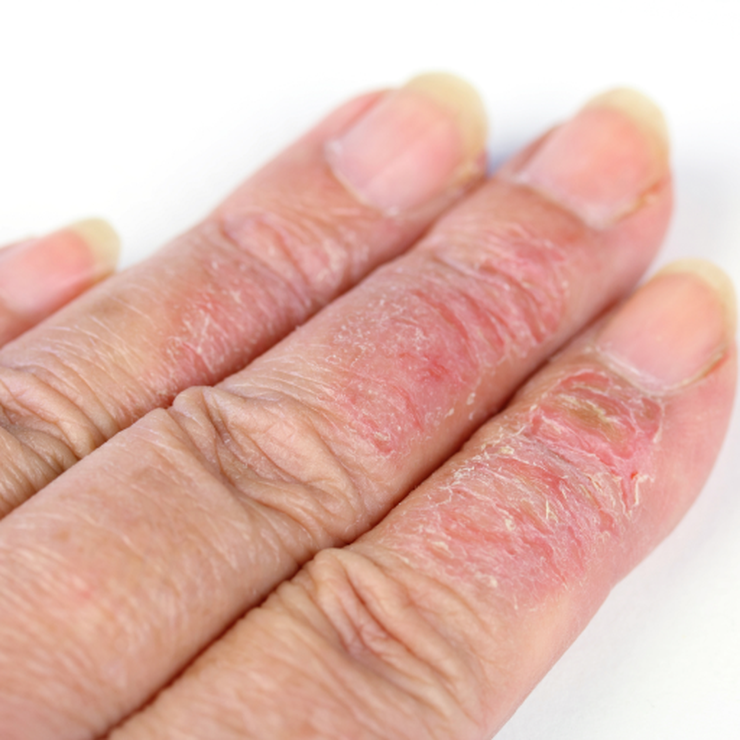 Hautveränderungen der Hand – Ursachen & Behandlung