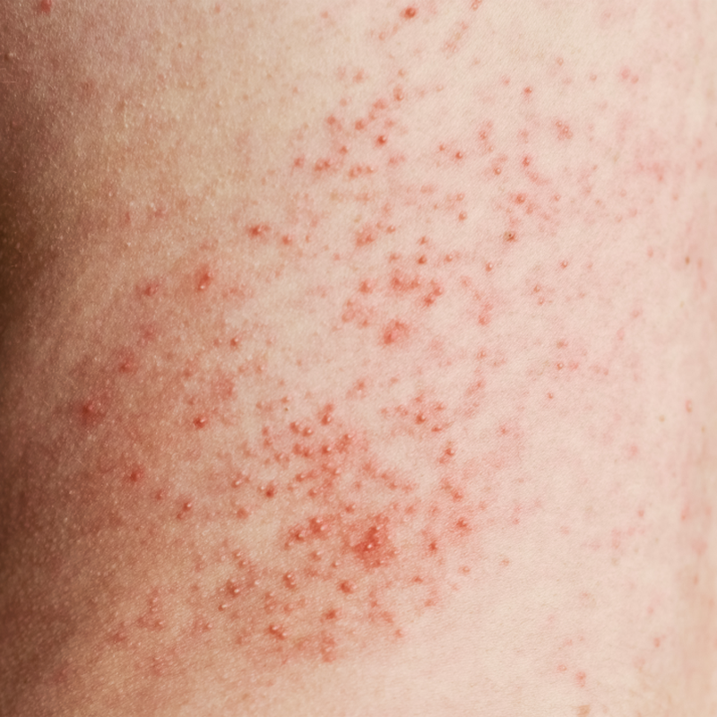 Alle Akne-Arten im Überblick – Starte Deine Haut-Analyse