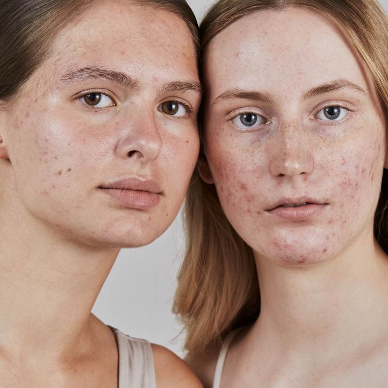 Alle Akne-Arten im Überblick – Starte Deine Haut-Analyse