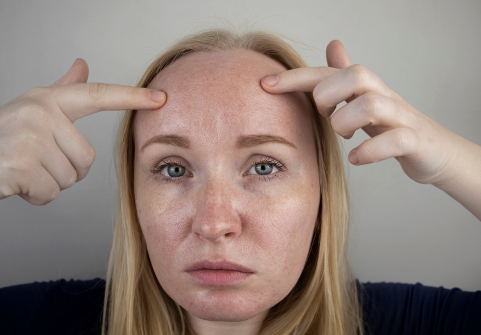 Fettige Stirn – Symptome, Ursache und Behandlung