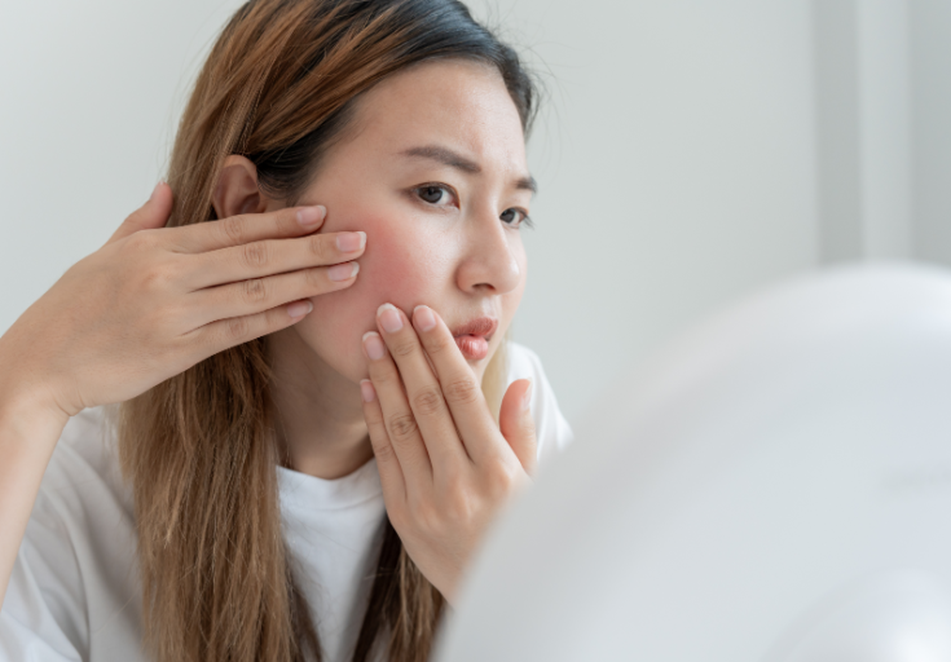 Pusteln Rosacea: So behandelst du sie erfolgreich