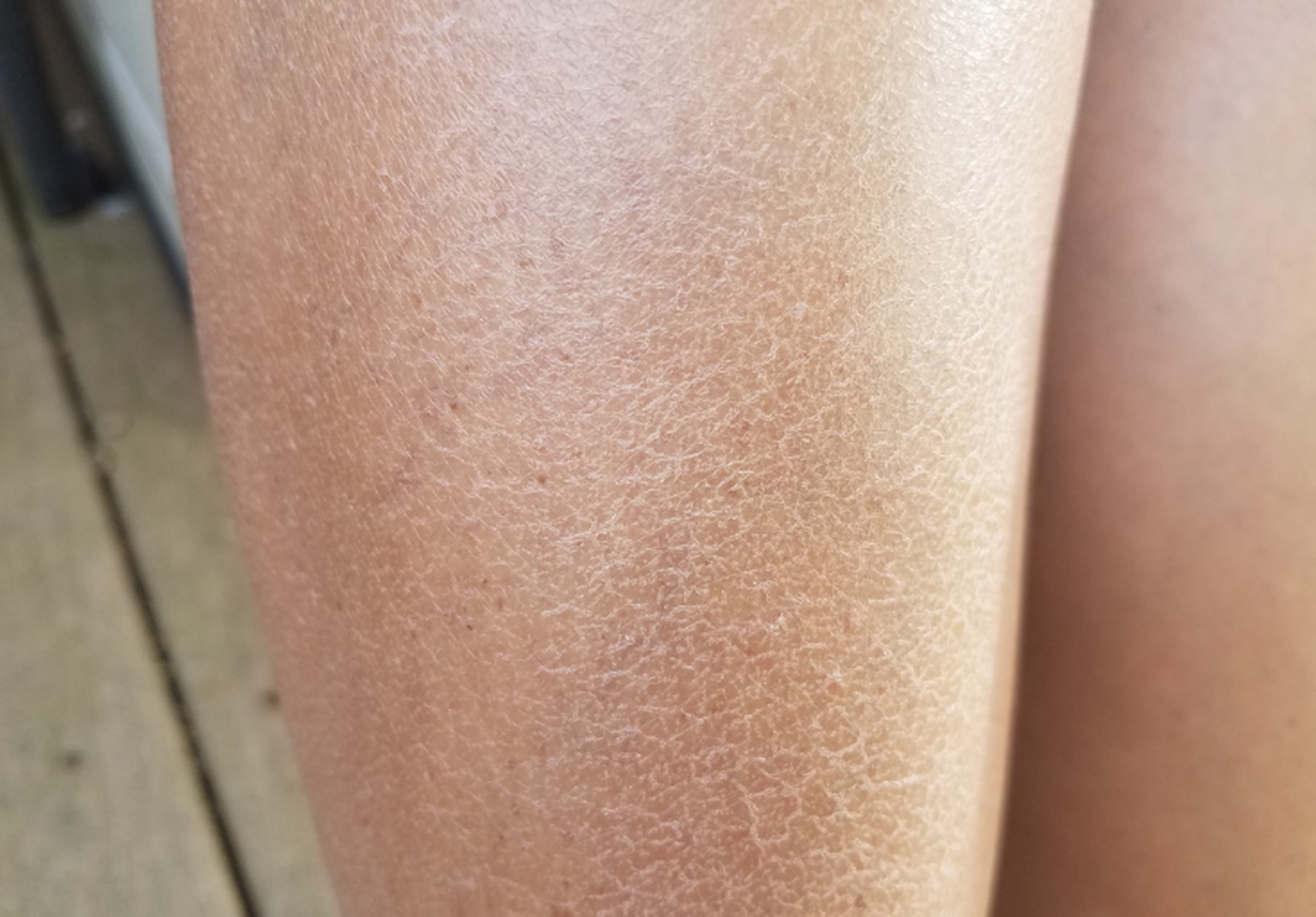 Pergamenthaut – alles über die Symptome & Behandlung