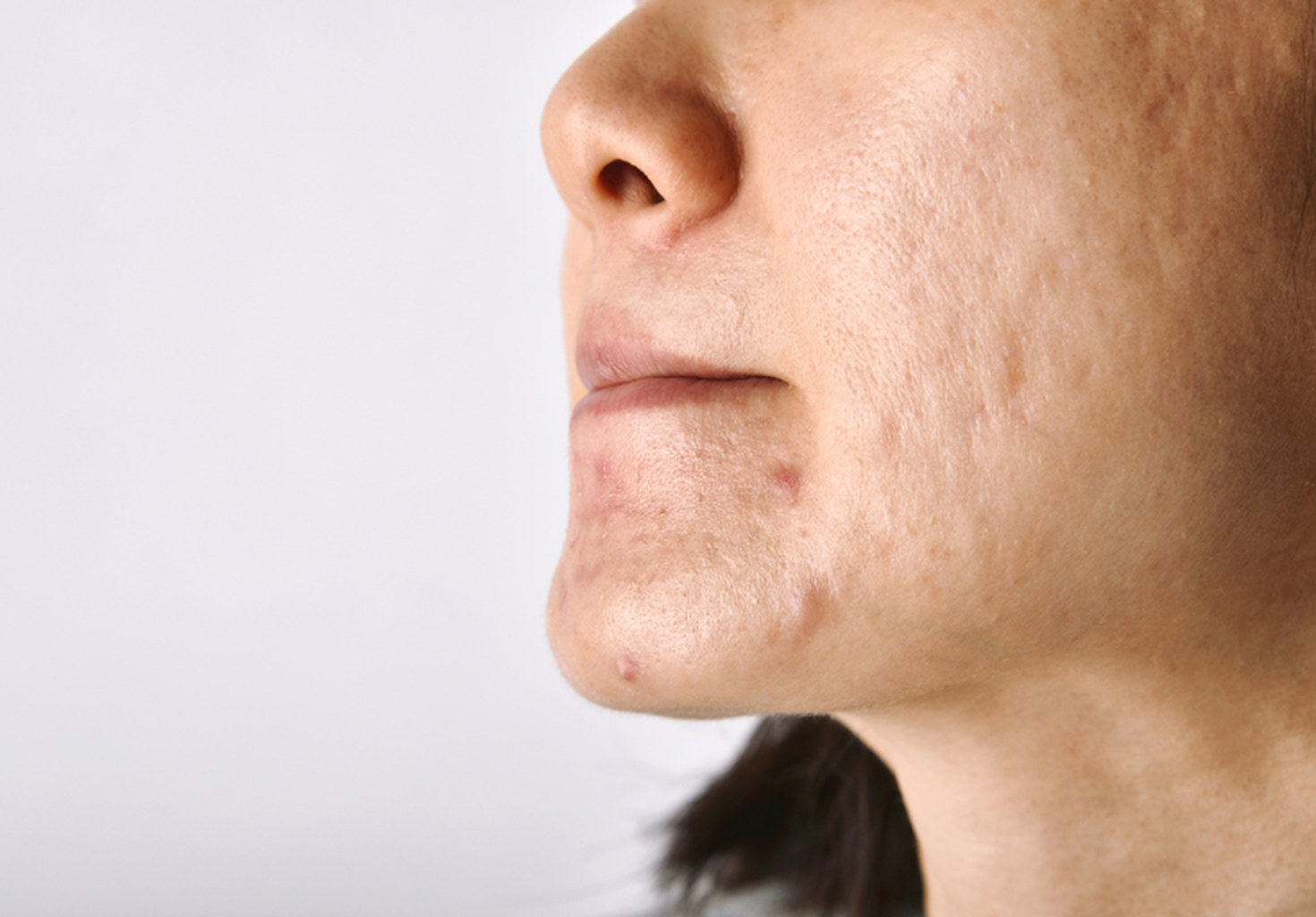 Unterirdische Pickel loswerden – wir helfen weiter