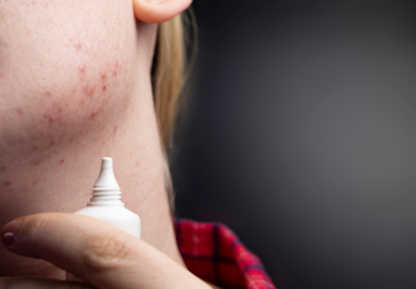 Pickel – alles über Ursachen, Behandlung & Lösungen