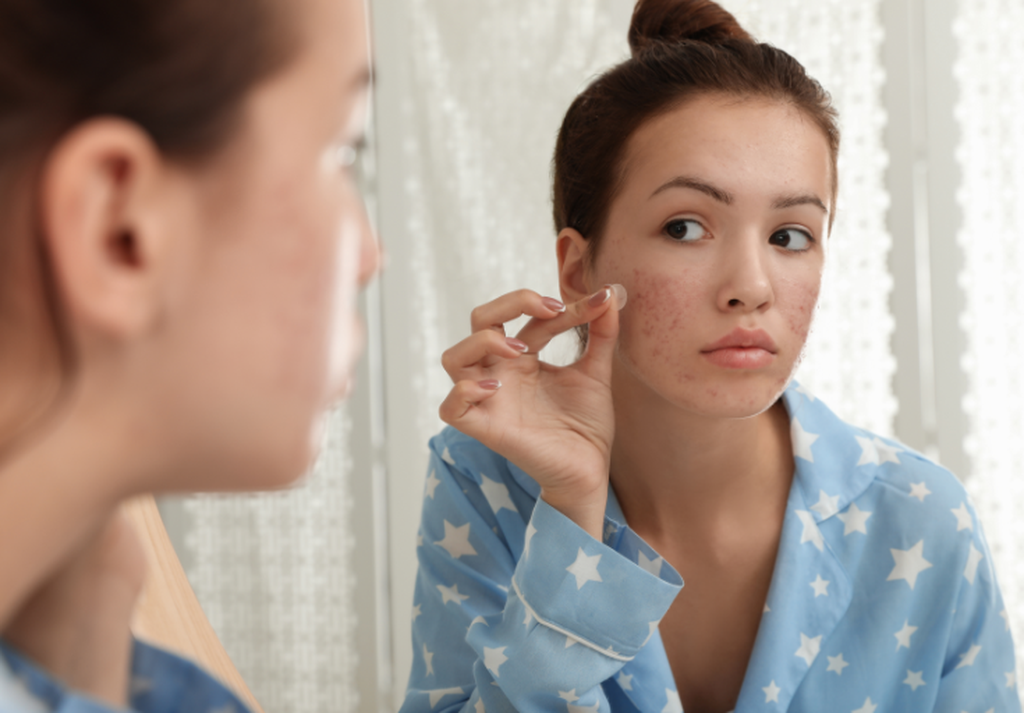 Alle Akne-Arten im Überblick – Starte Deine Haut-Analyse