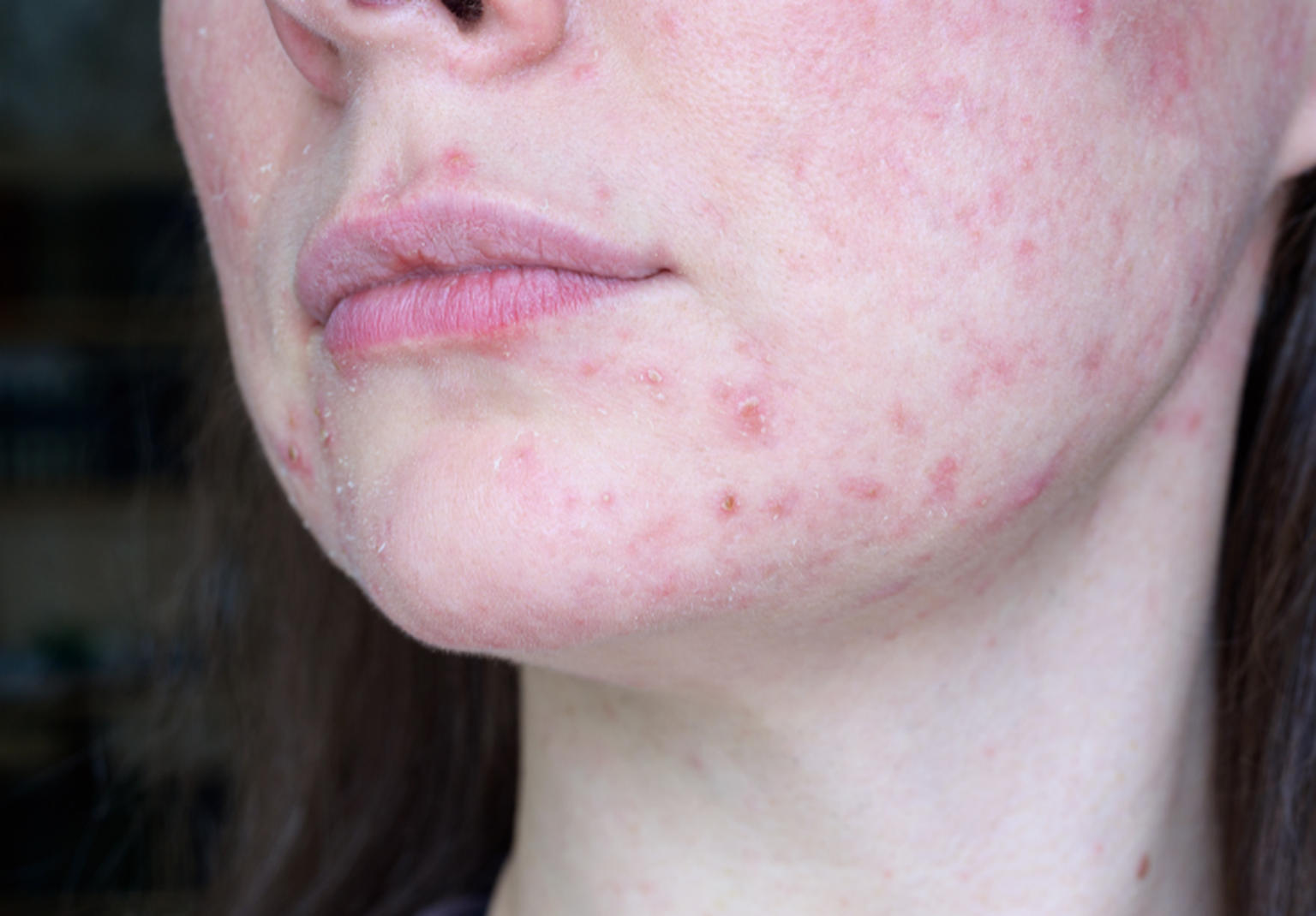Rote Flecken im Gesicht – wirksame Behandlungsmethoden