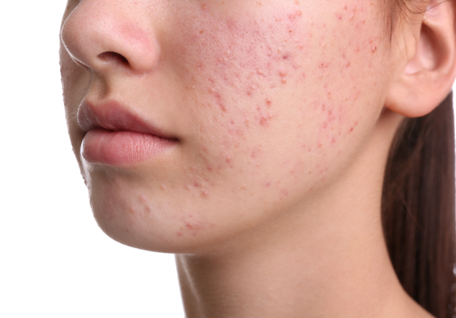 Medikamente gegen Akne – Jetzt Unterschiede kennenlernen