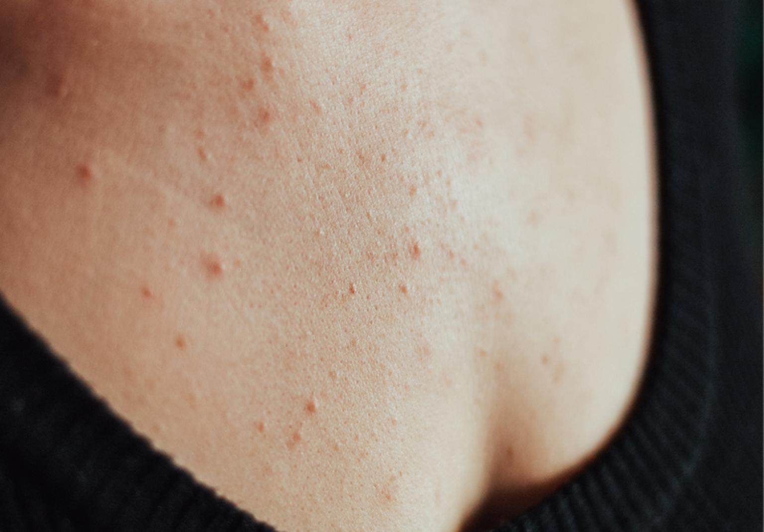 Juckende Pickel Unter Der Brust - Baby Schwanger