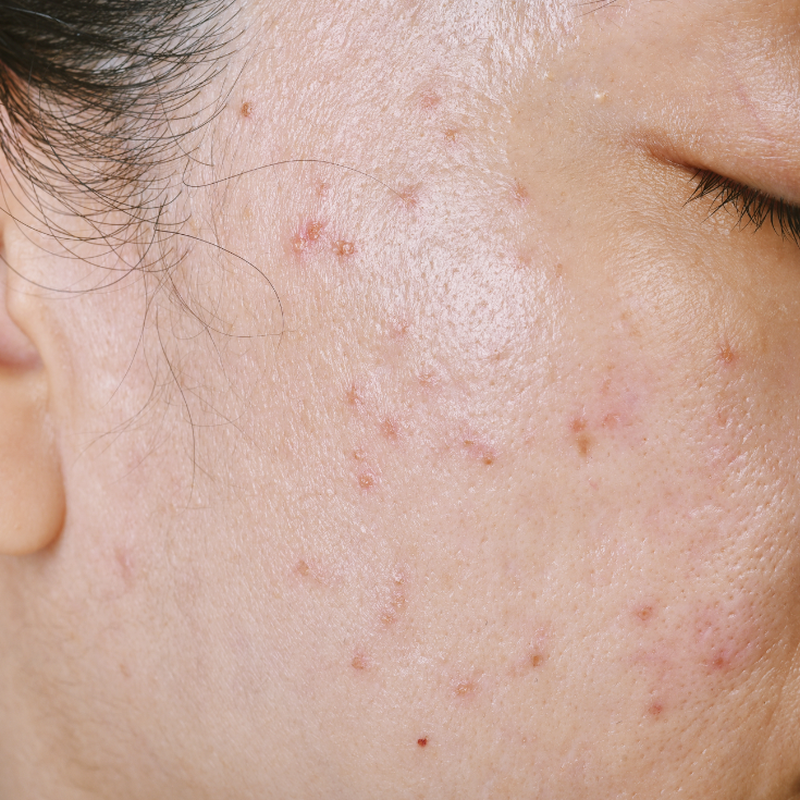 Alle Akne-Arten im Überblick – Starte Deine Haut-Analyse