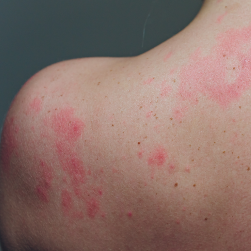 Alle Akne-Arten im Überblick – Starte Deine Haut-Analyse