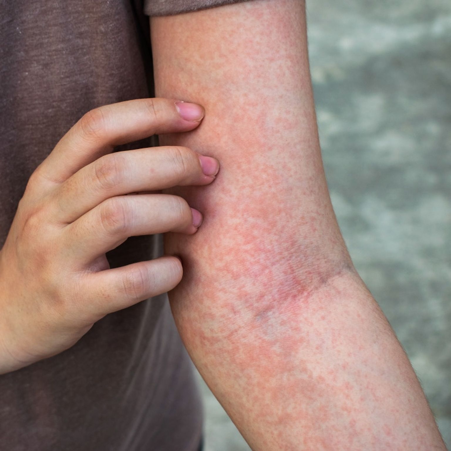 Ist Neurodermitis ansteckend? | Jetzt herausfinden!