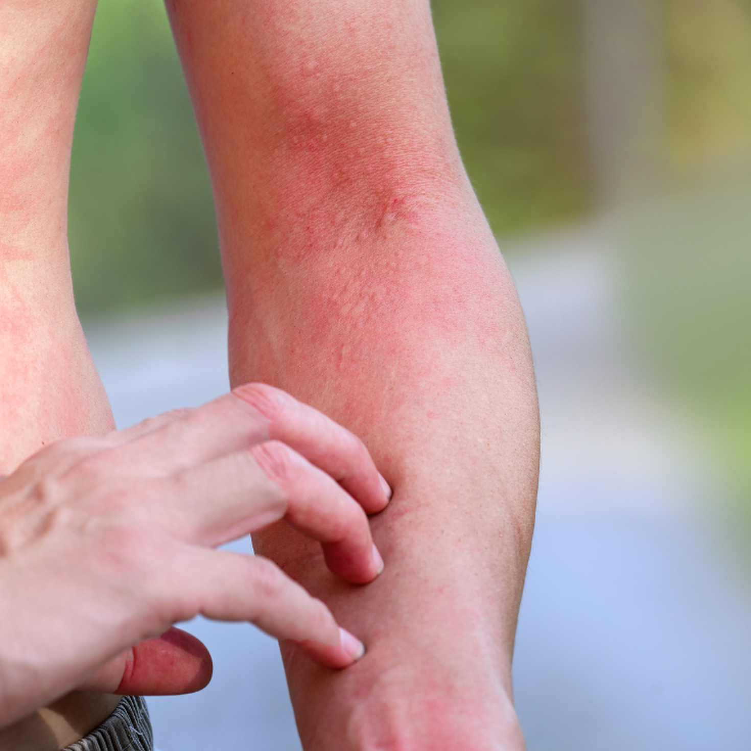 Neurodermitis am Ellenbogen – Deine passende Behandlung