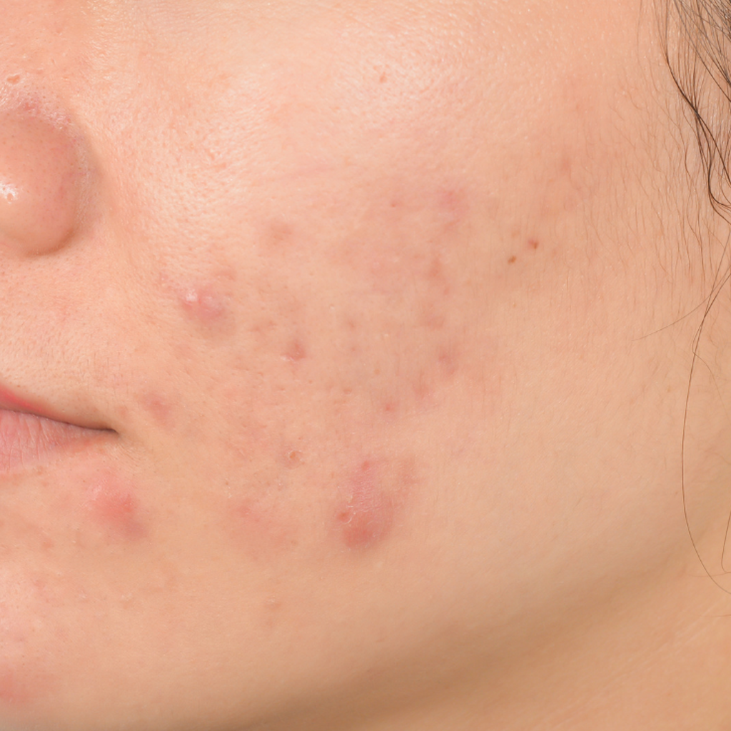 Was hilft gegen Pickelnarben? – Behandlungen & Wirkung