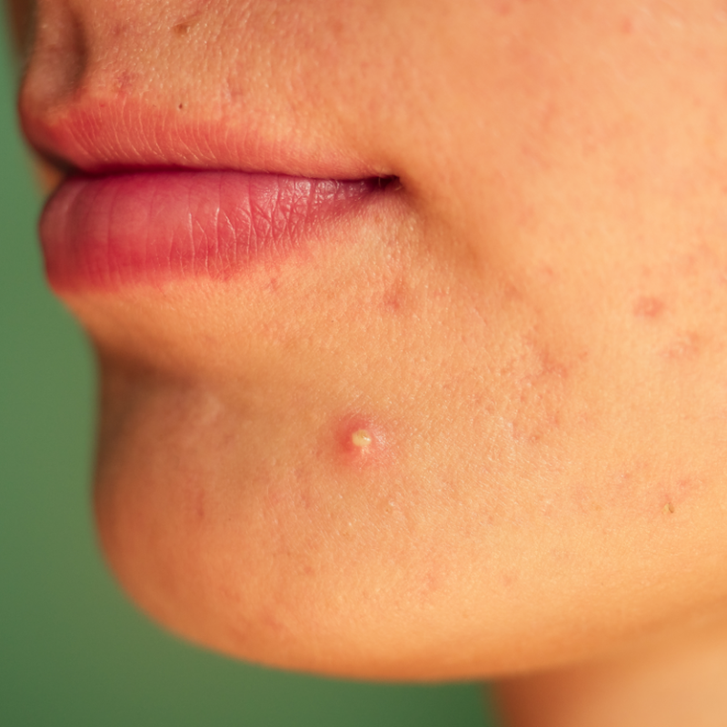 Alle Akne-Arten im Überblick – Starte Deine Haut-Analyse