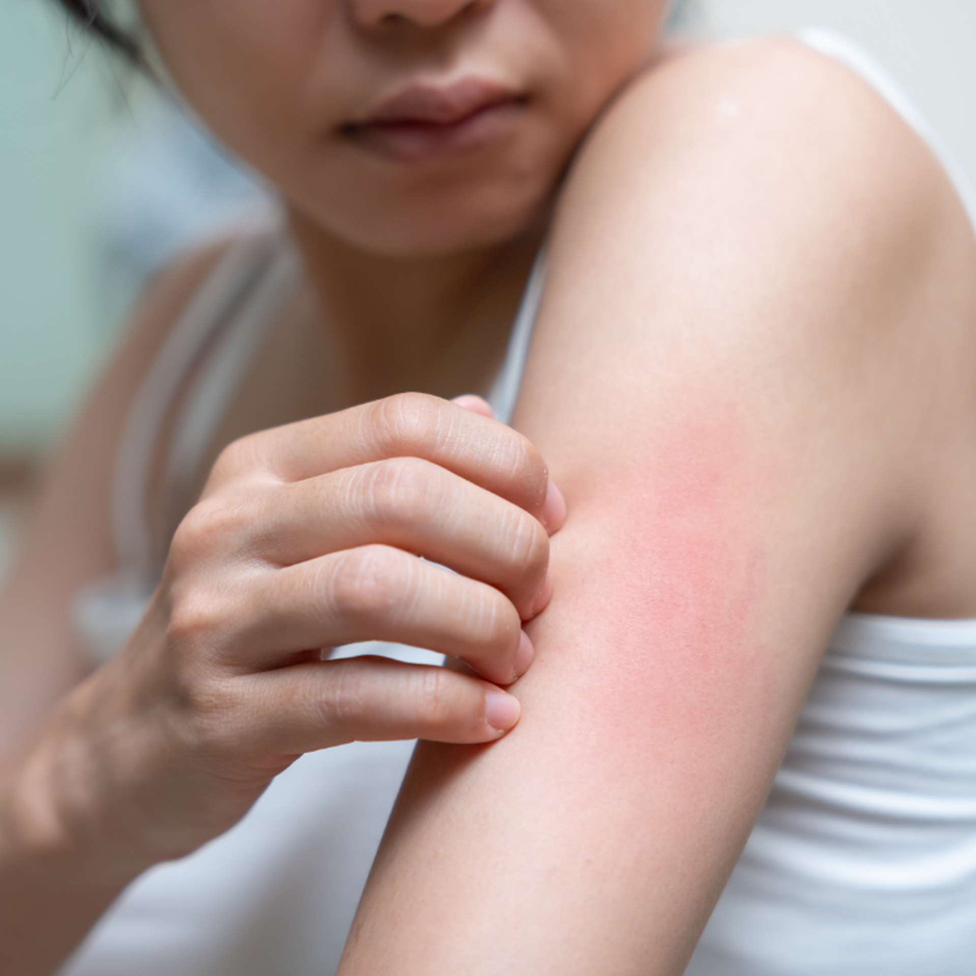 Hitzepickel – Ursachen & effektive Behandlungstipps