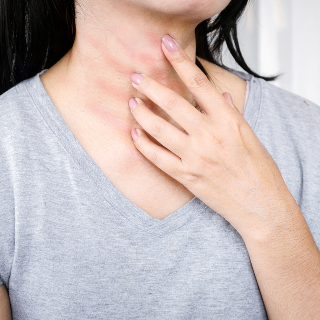 Neurodermitis – Symptome, Ursachen & Behandlung