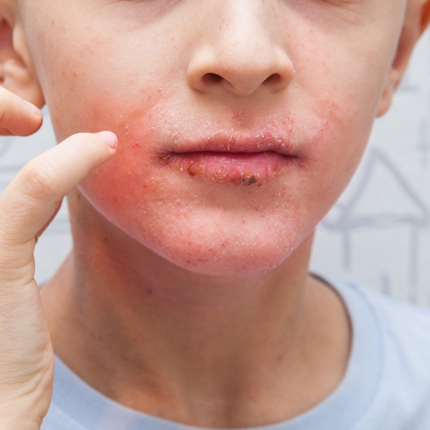 SCORAD Neurodermitis – so Schweregrad herausfinden