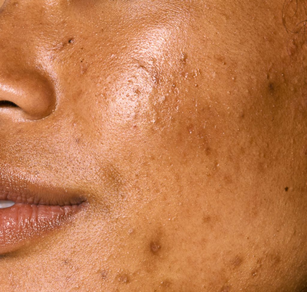 Pickel auf den Wangen – so wirst Du sie effektiv los!