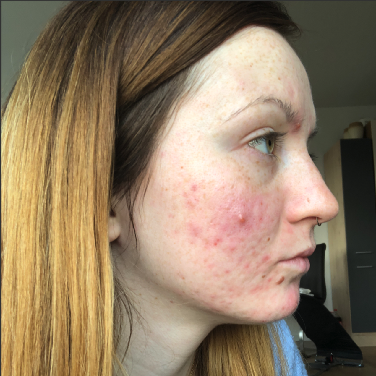 Entzündete Pickel im Gesicht wirksam loswerden!