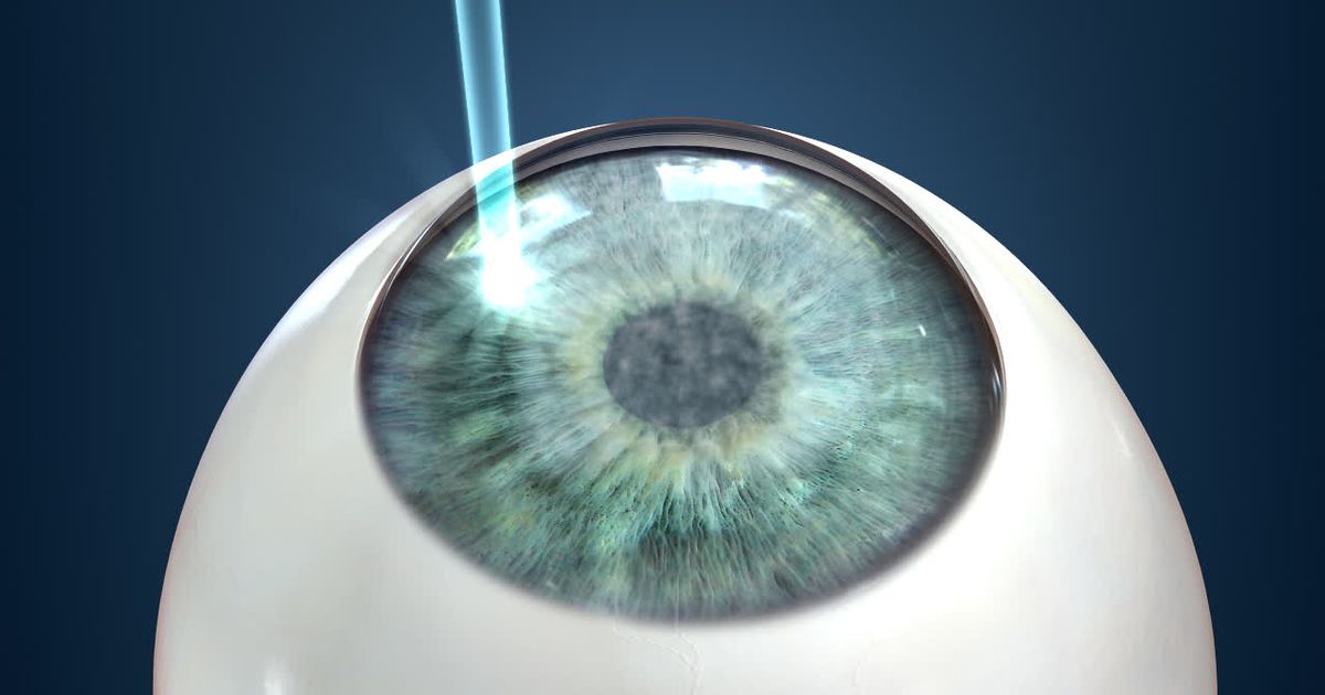 Venti anni dall’approvazione FDA della LASIK