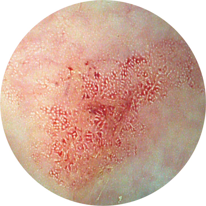 Virtual chromoendoscopy: PENTAX Medical i-scan technology