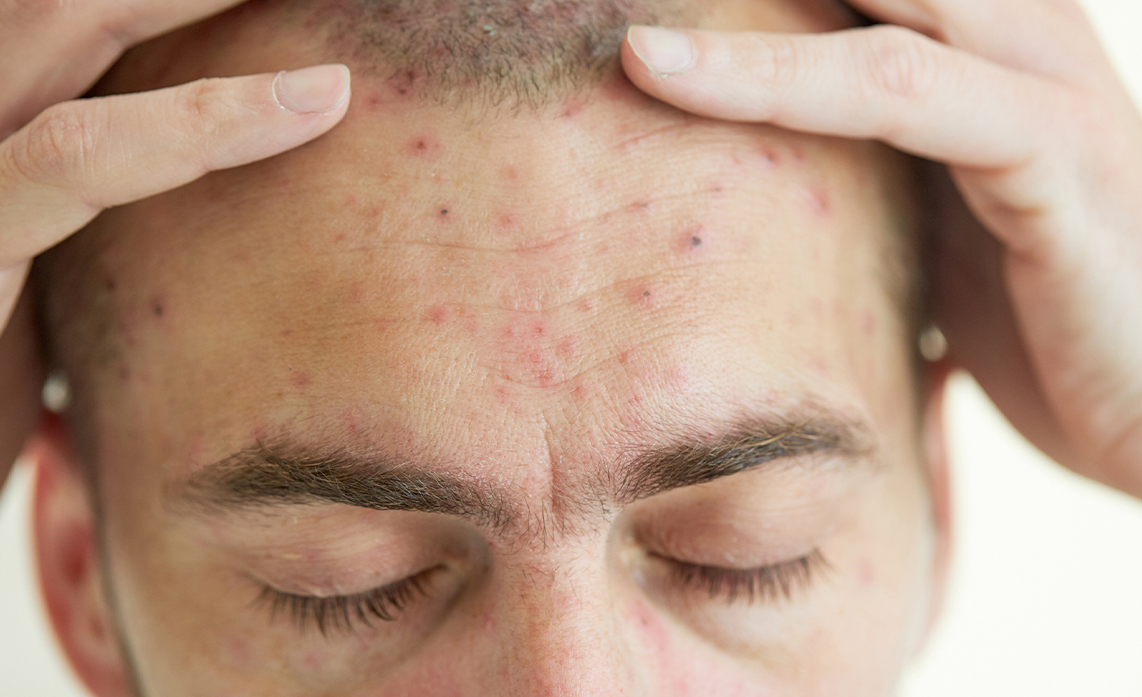 Skin Conditions | Winter Acne And How to Treat | Pharmacy2U