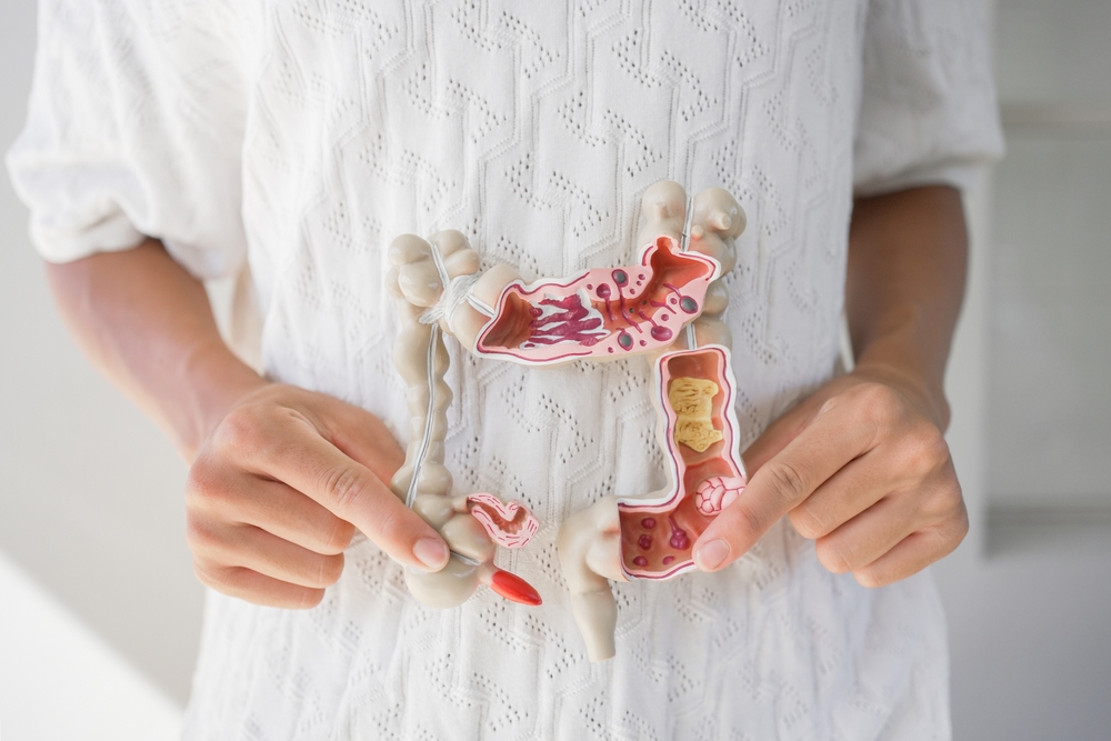 Tumore colon retto: sintomi, screening e cure