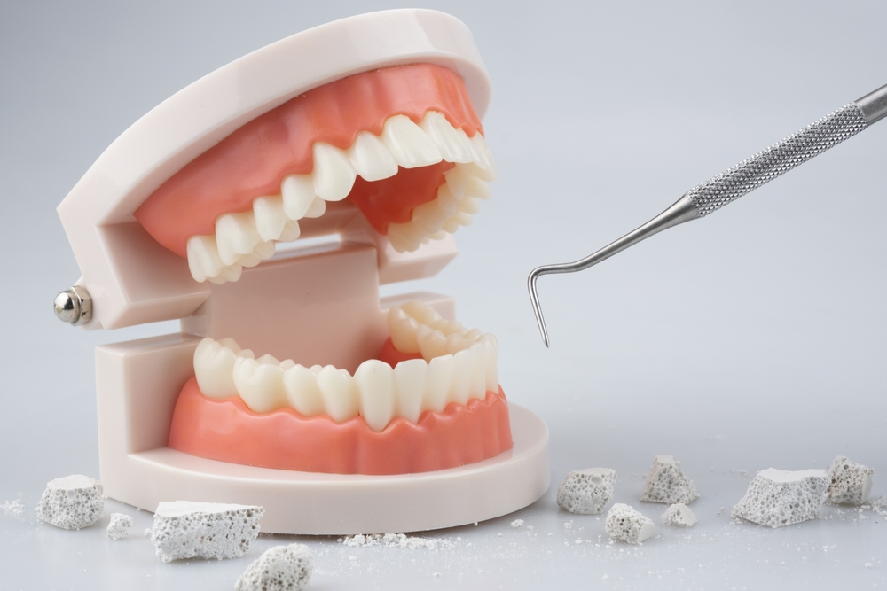 Placca dentale: cos’è, cause e come eliminarla