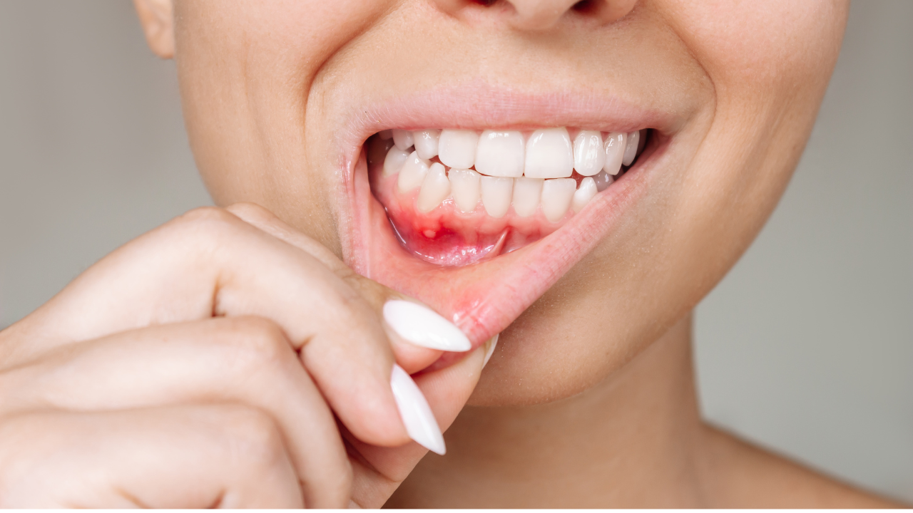 Afta in bocca: cause, sintomi, durata e rimedi efficaci