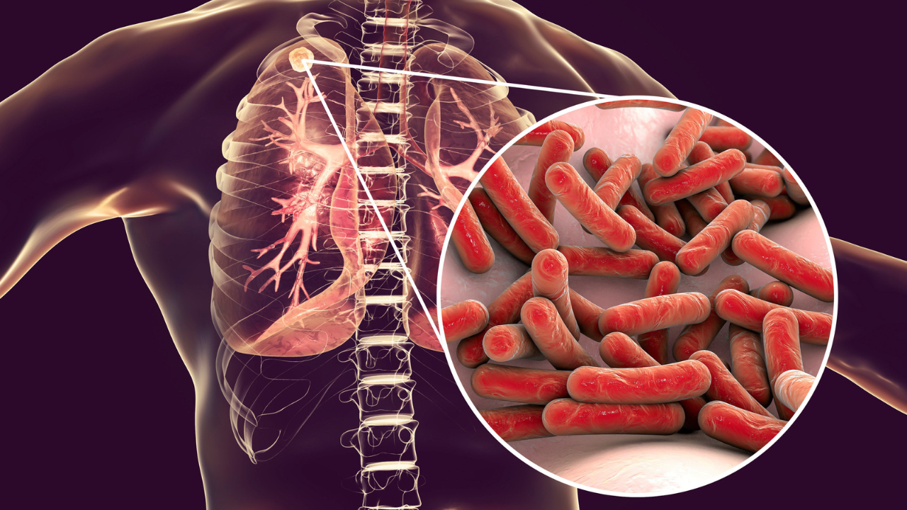Tubercolosi: Cos’è, Sintomi, Come si Trasmette e Contagiosità | Guida ...