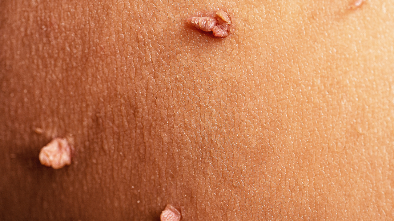 Fibroma cutaneo: cause, sintomi e trattamenti efficaci