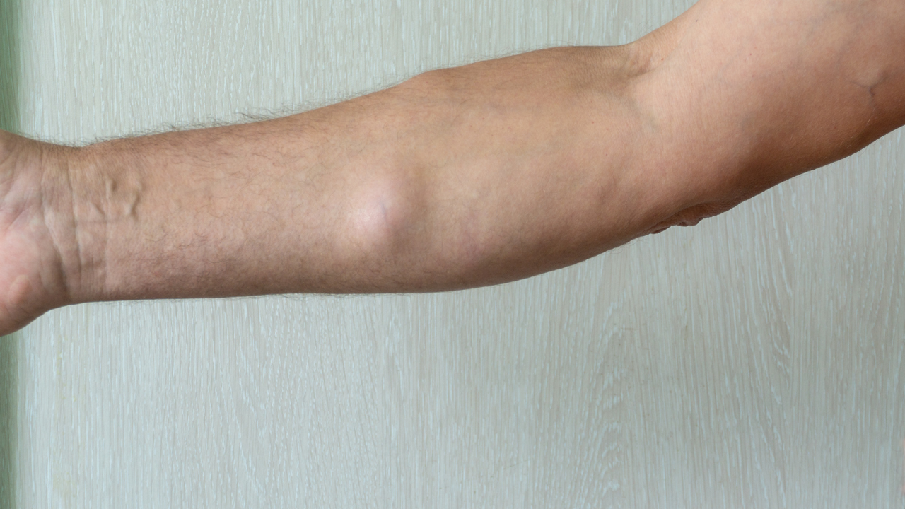 Basalioma: cos'è, sintomi e quando preoccuparsi