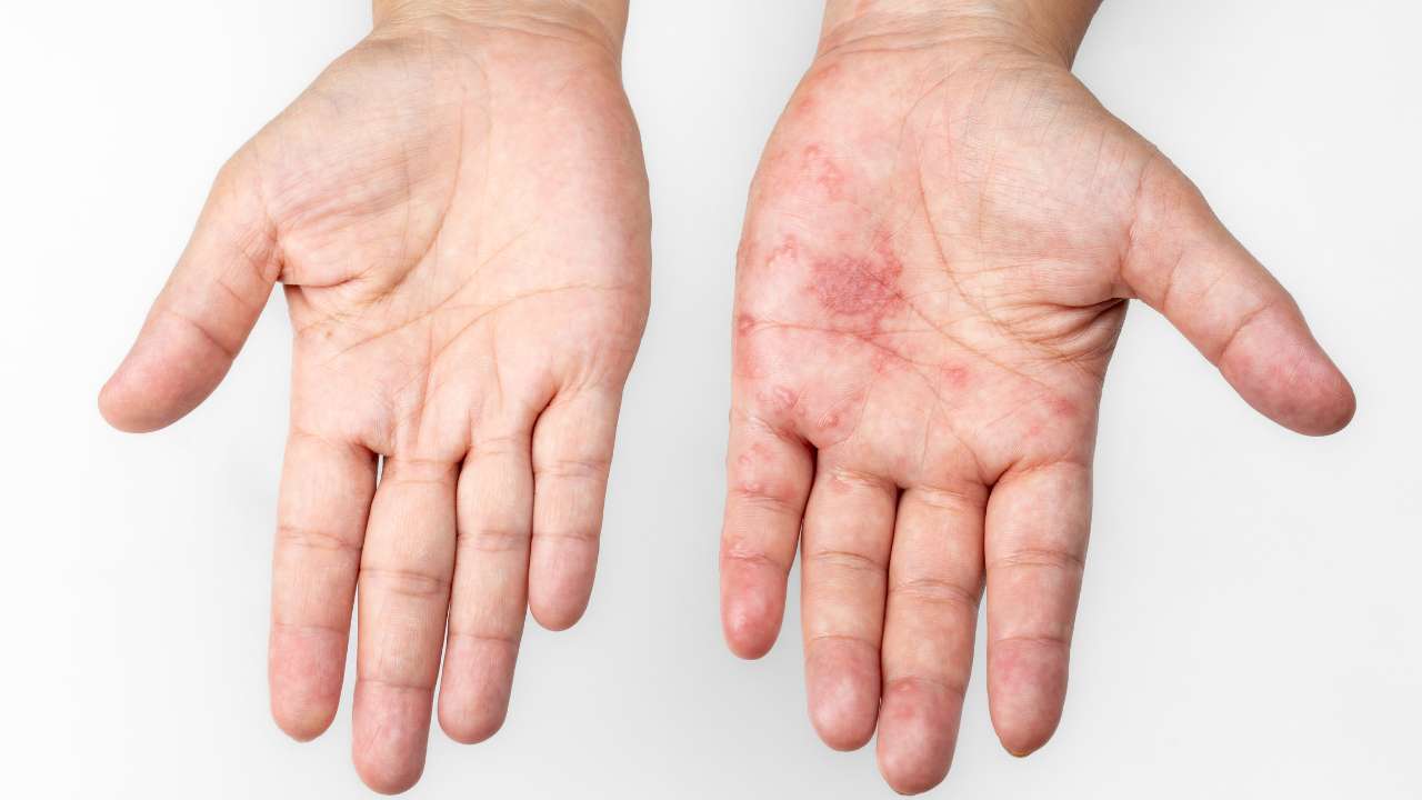Scabbia: sintomi, contagio e trattamenti efficaci