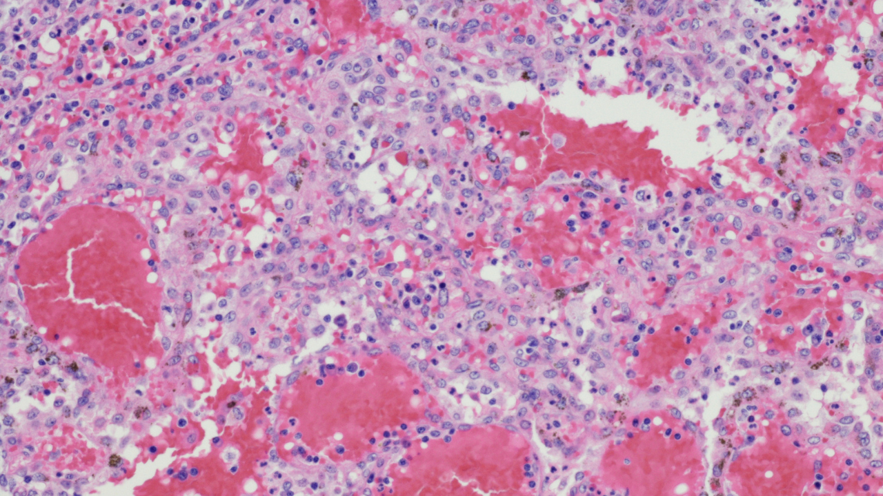 Angioma: tipi, sintomi, cause e quando preoccuparsi