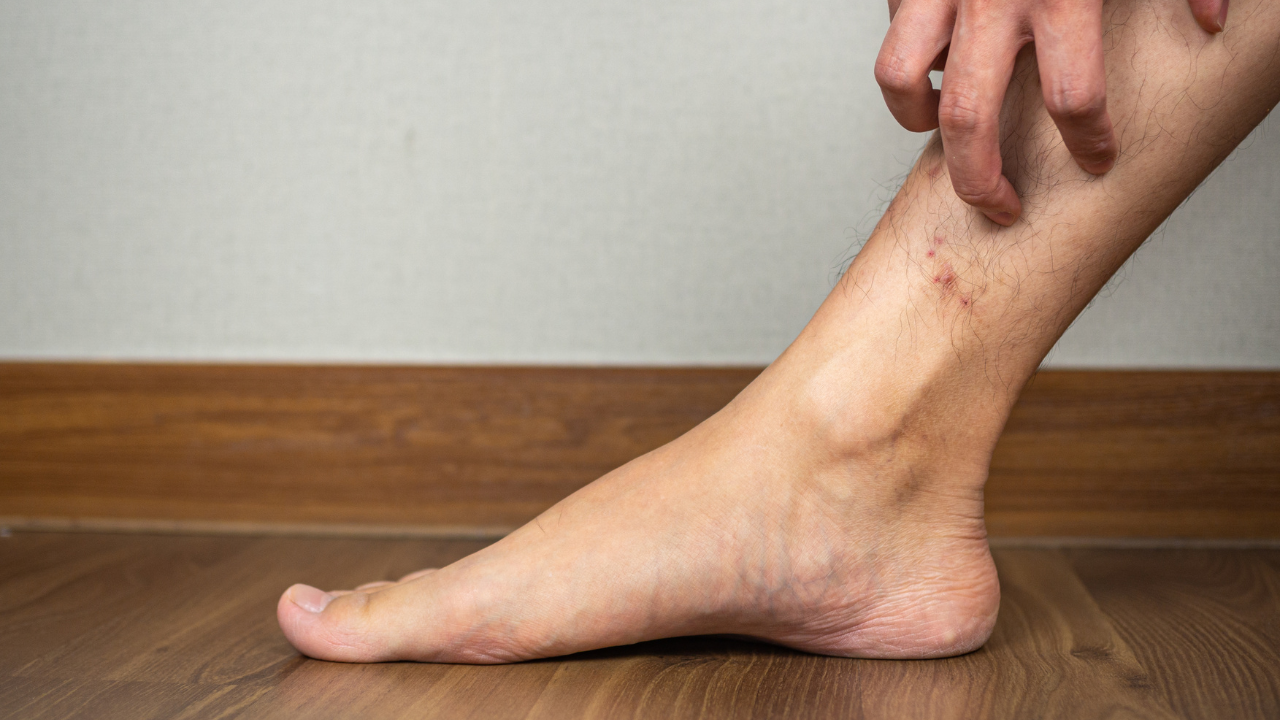 Prurito caviglie: identificare le cause e alleviare il disagio