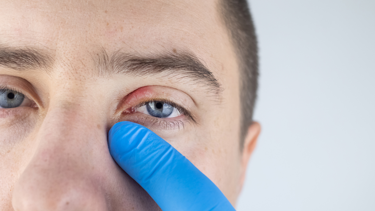 Blefarite: cause, sintomi e cure per occhi infiammati