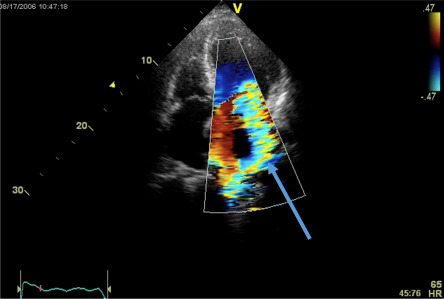 Ecocolordoppler cardiaco: cosa è, come funziona e quando farlo