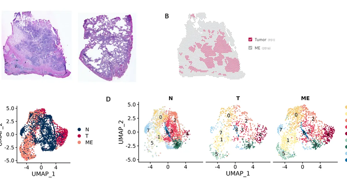 Combining cancer patient spatial transcriptomics and bulk rna-seq data ...